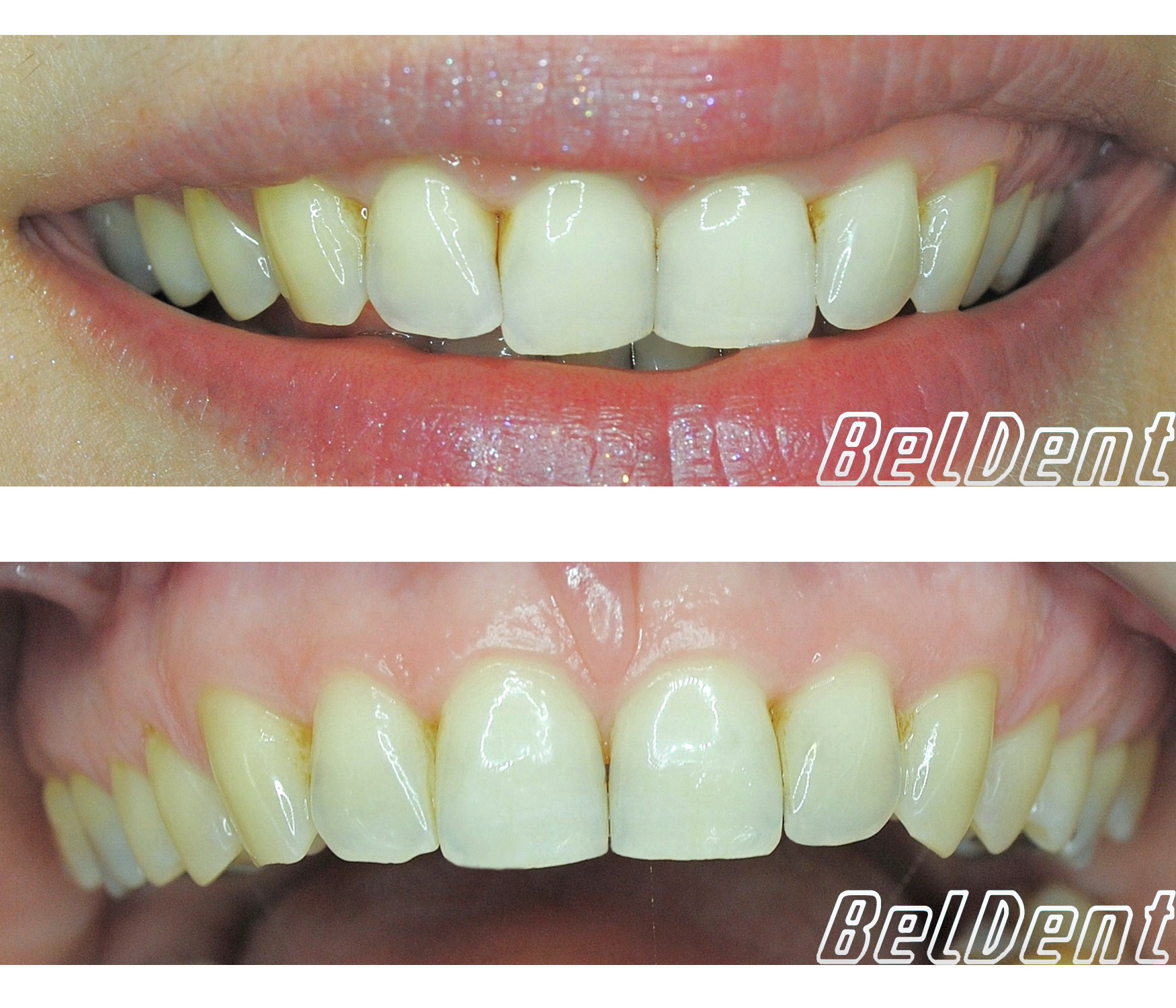 Ispravljanje zuba folijama.BelDent dental studio